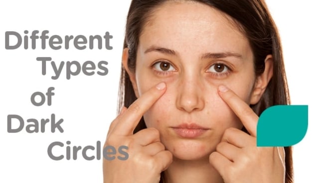 The Different Types of Dark Circles, Which Do You Have? | SHOPPE.LK