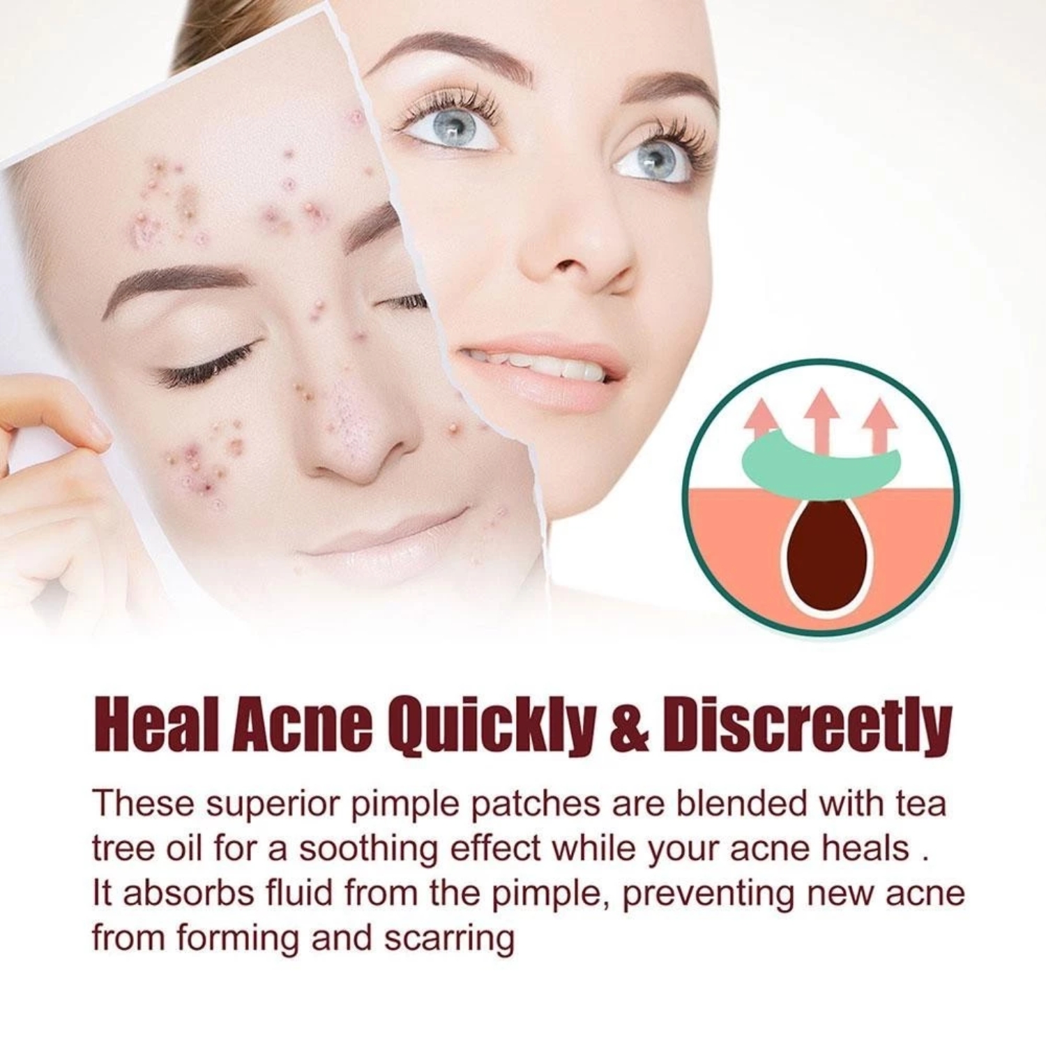 JAYSUING Acne Pimple Patch - Professional Grade 200Pcs | SHOPPE.LK